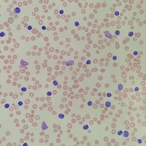 Smudge Cells: Identification & Differentiation