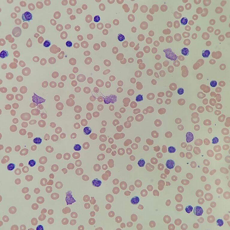 Smudge Cells: Identification & Differentiation