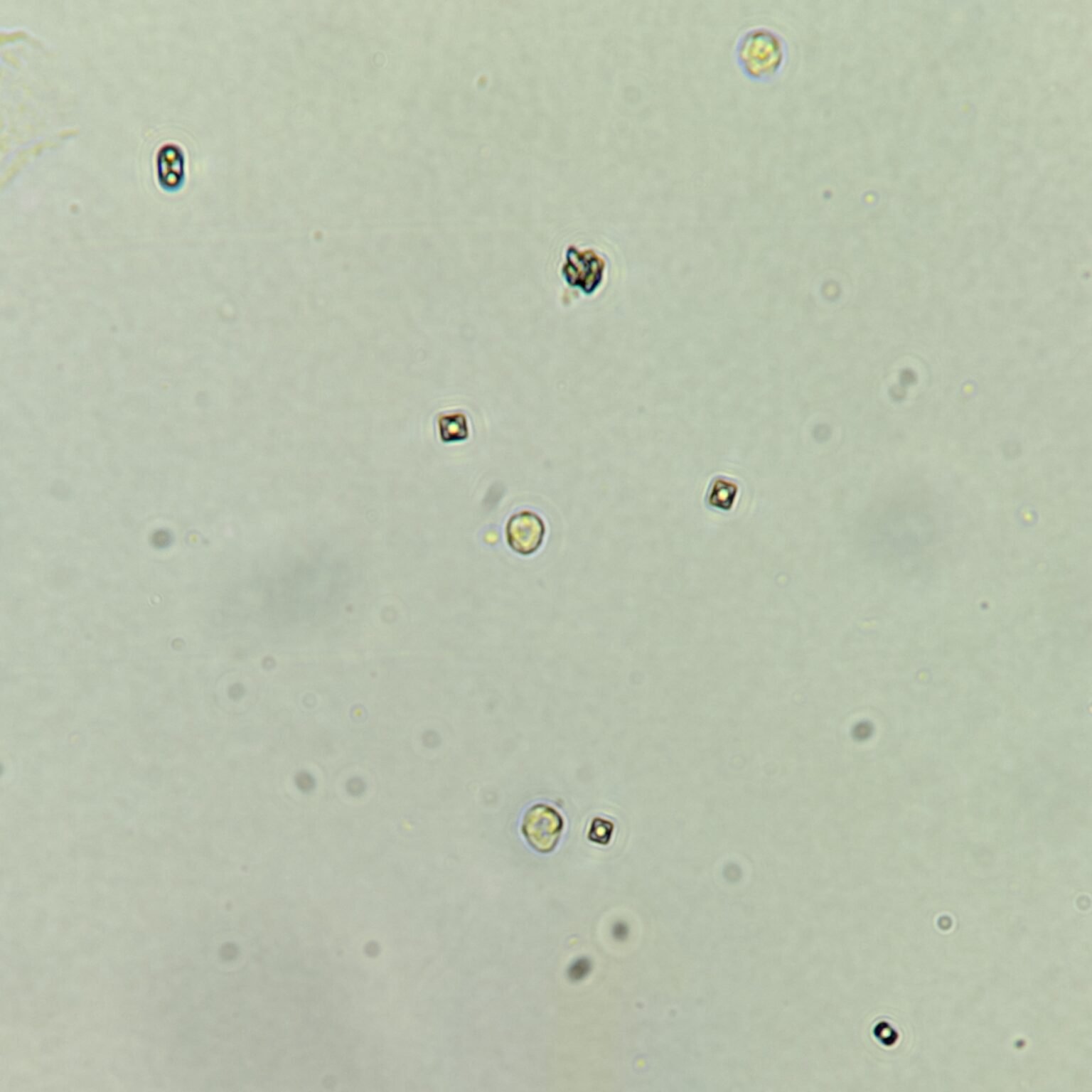 Urinary Crystals: Identification & Clinical Significance