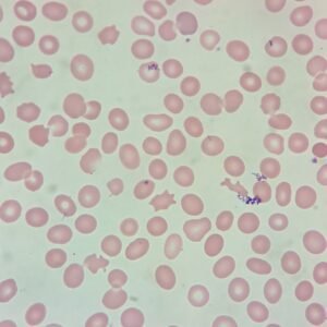 Acanthocytes (Spur Cells) on Blood Smear: Morphology & Causes