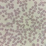 Acanthocytes (Spur Cells) on Blood Smear: Morphology & Causes