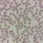 Acanthocytes (Spur Cells) on Blood Smear: Morphology & Causes
