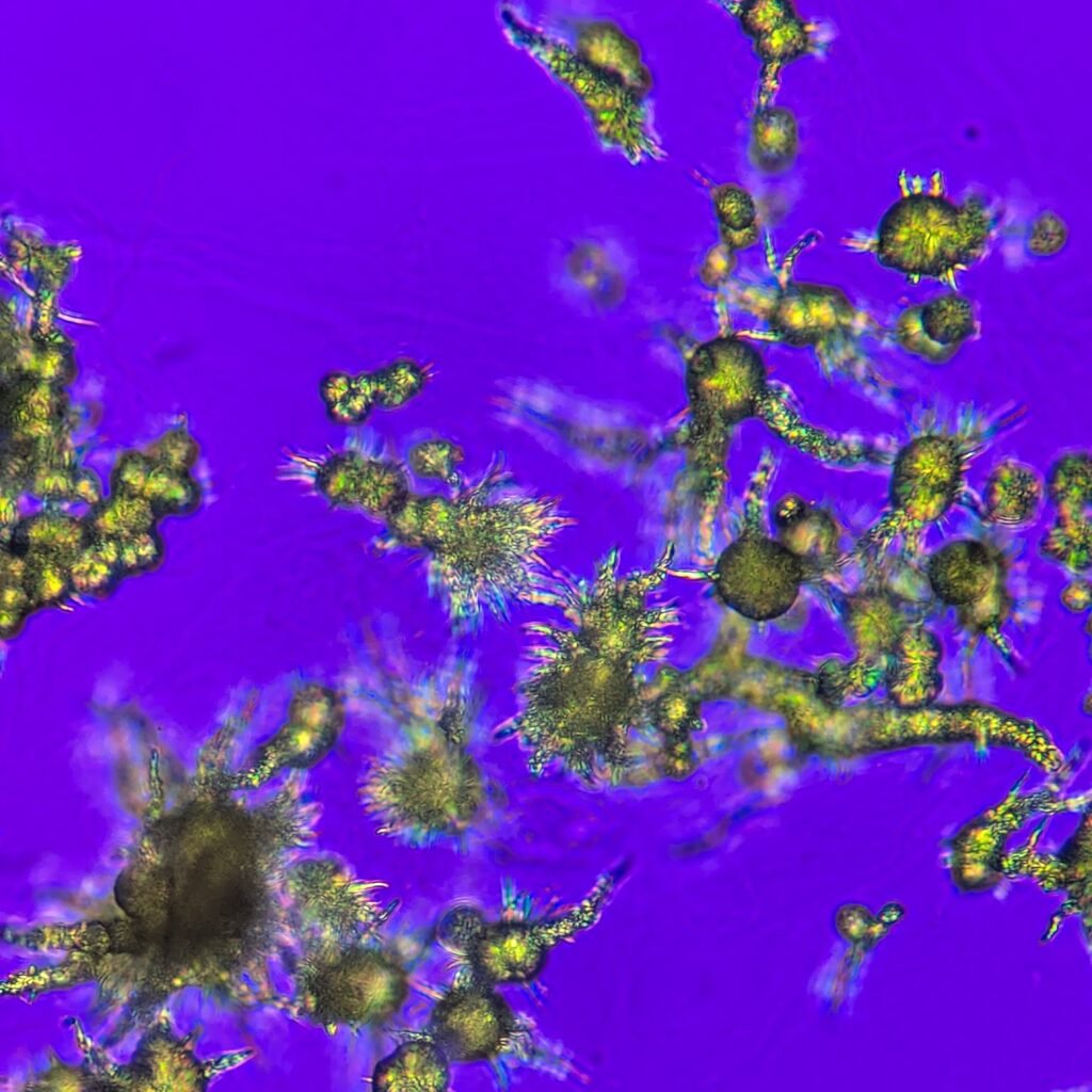 Leucine Crystals: Identification & Clinical Significance