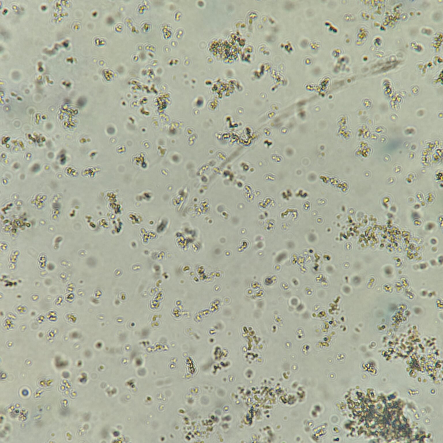 Amorphous Urates: Identification & Clinical Significance