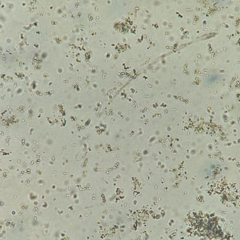 Amorphous Urates: Identification & Clinical Significance