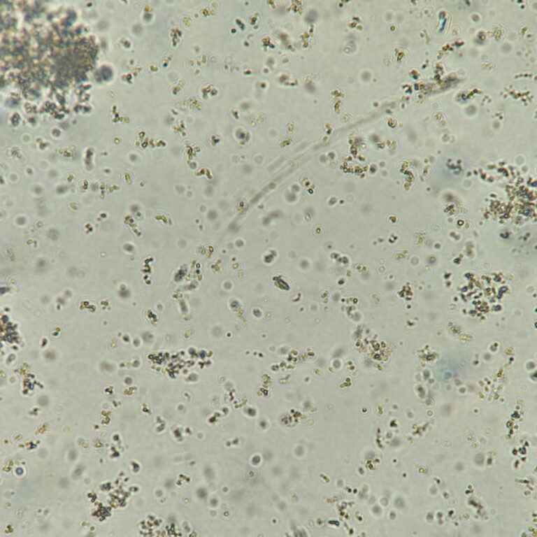 Amorphous Urates: Identification & Clinical Significance