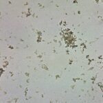 Amorphous Urates: Identification & Clinical Significance