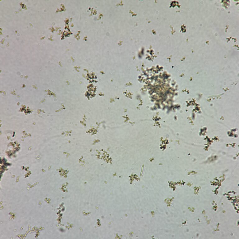 Granular Casts: Identification & Significance - MedLabBuddy