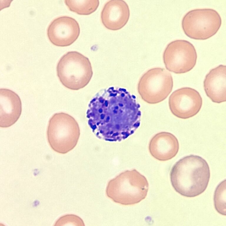 Blast Cells: Identification & Differentiation