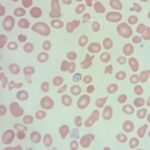 RBC Inclusions: Appearance & Clinical Significance