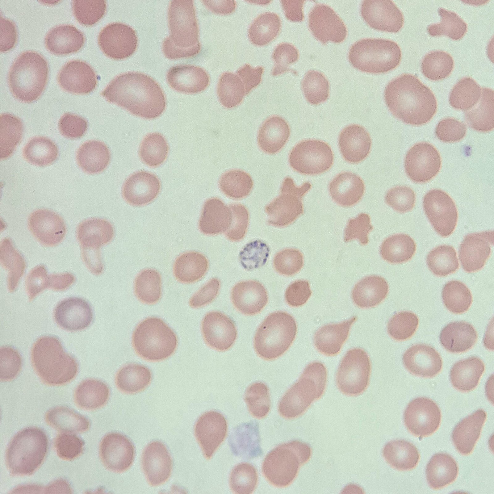Basophilic Stippling - MedLabBuddy