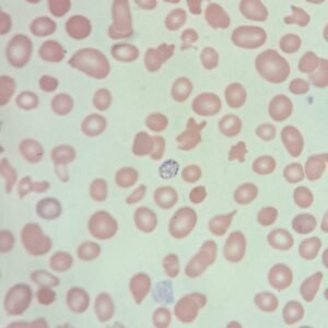 RBC Inclusions: Appearance & Clinical Significance
