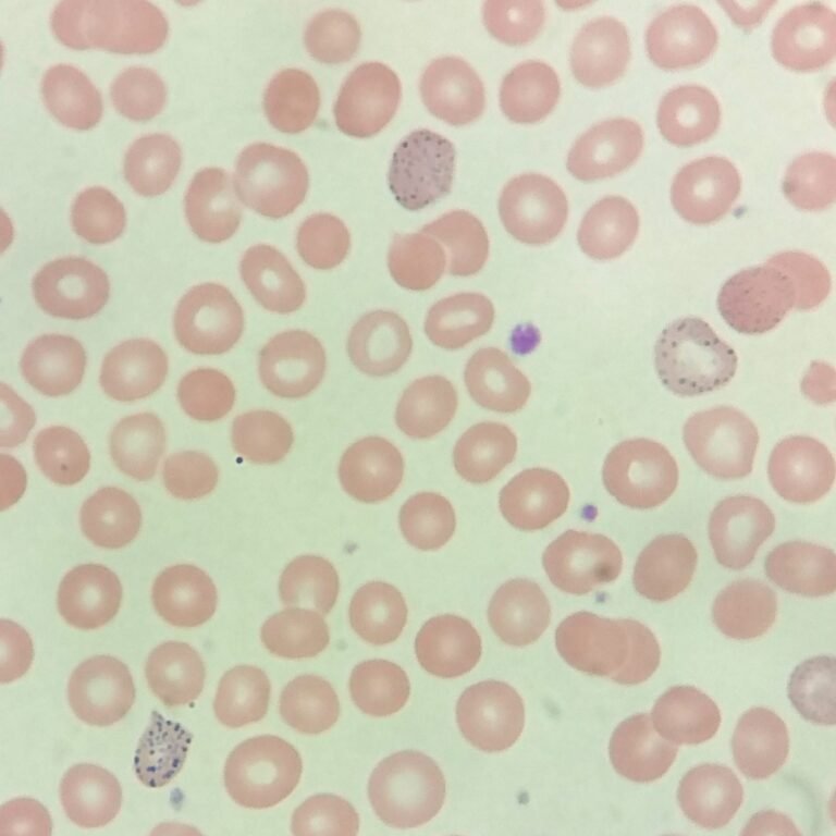 RBC Inclusions: Appearance & Clinical Significance