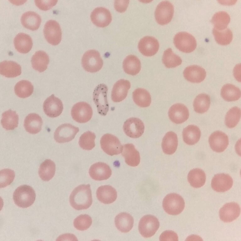 Basophilic Stippling - MedLabBuddy