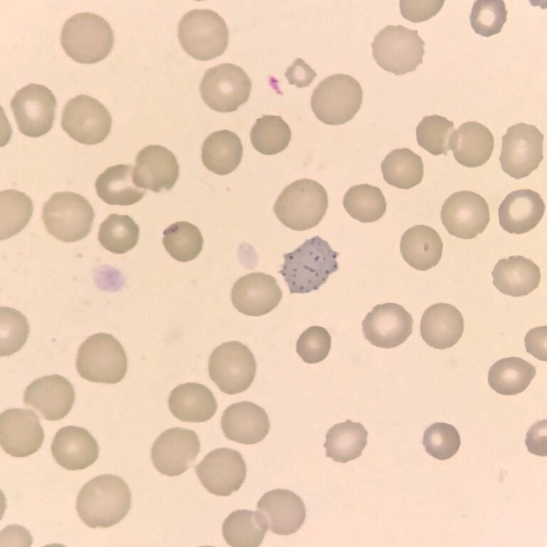 RBC Inclusions: Appearance & Clinical Significance