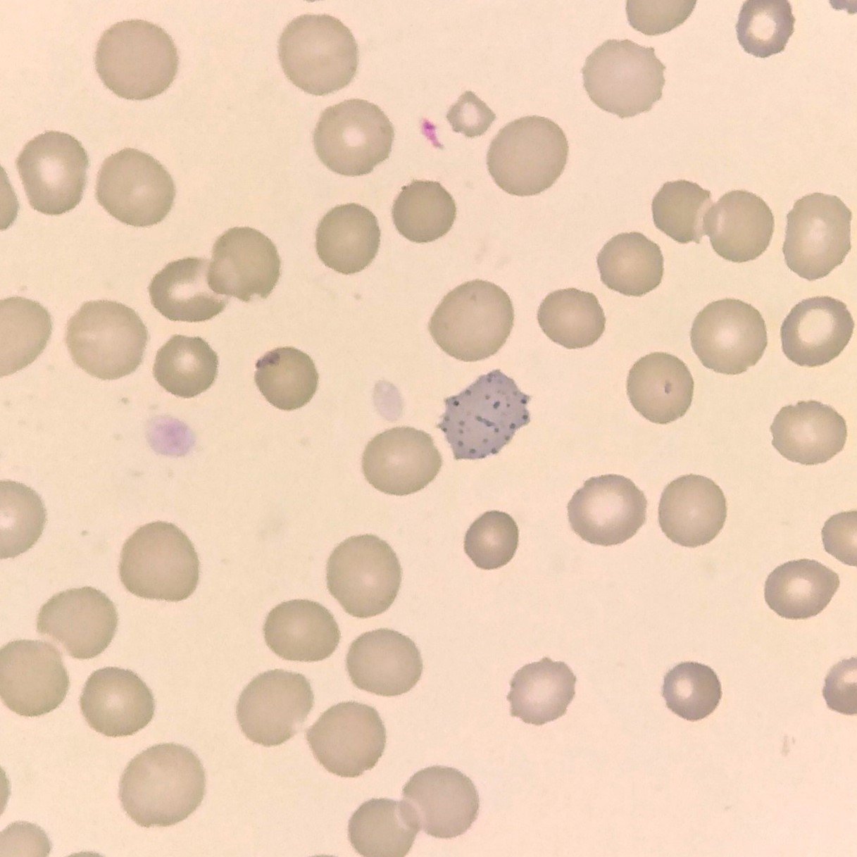 RBC Inclusions: Appearance & Clinical Significance