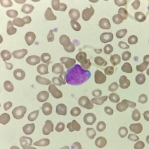 Blast Cells: Identification & Differentiation