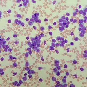 Blast Cells: Identification & Differentiation
