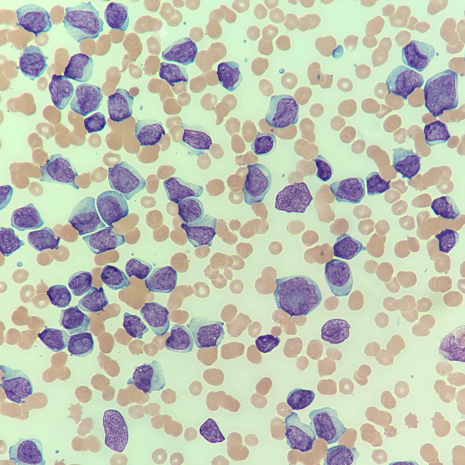 Blast Cells: Identification & Differentiation