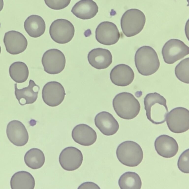 Blister & Bite Cells: Appearance & Clinical Significance - MedLabBuddy