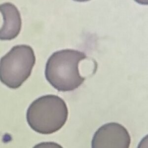 Blister & Bite Cells: Hematology Bench & MLS Study Guide