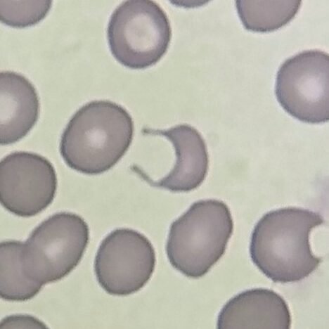 Blister & Bite Cells: Appearance & Clinical Significance - MedLabBuddy