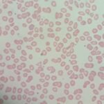 Burr Cells on Blood Smear: Identification & Significance