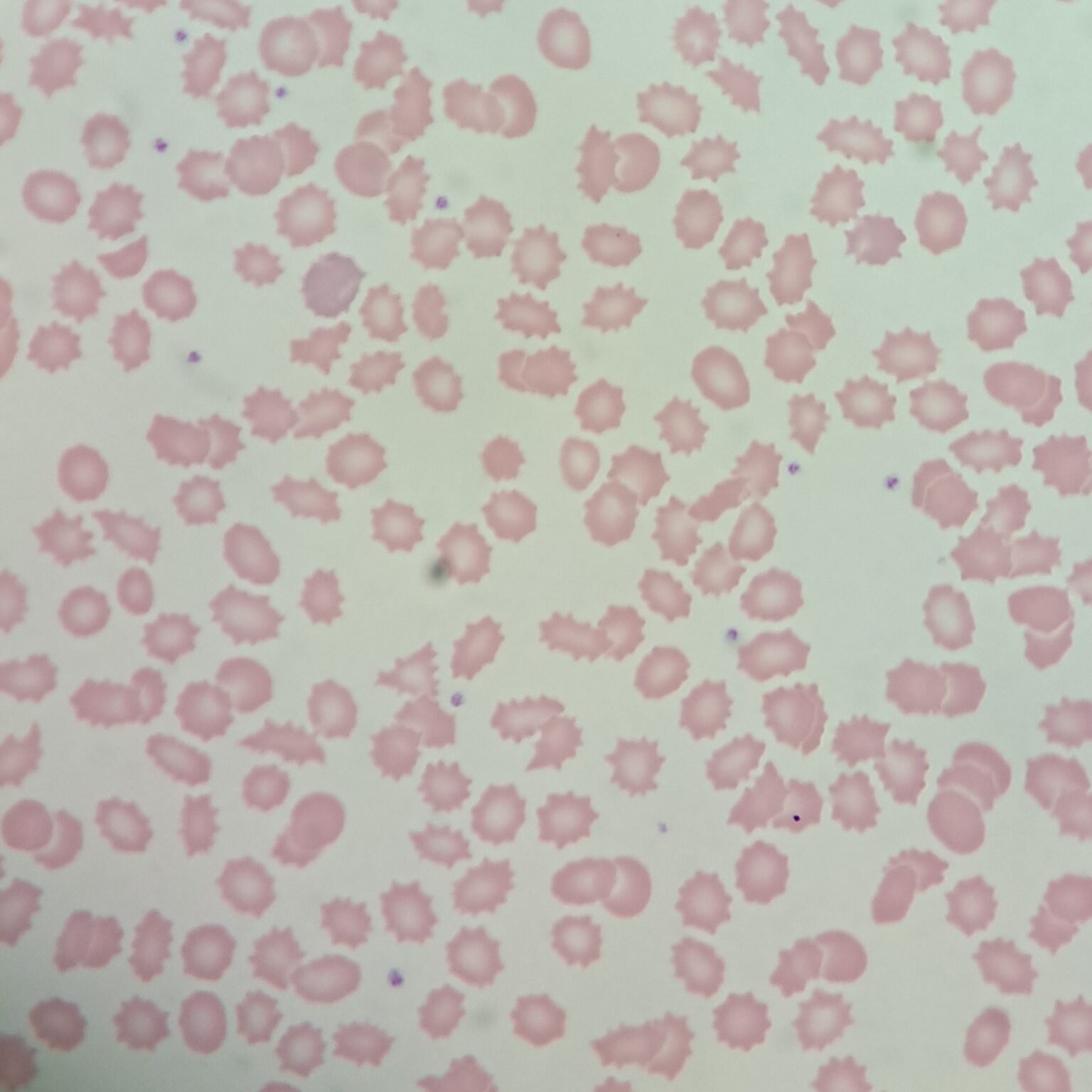 Teardrop Cells: Appearance & Clinical Significance - MedLabBuddy