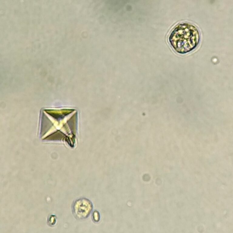Calcium Oxalate Crystals: Identification & Clinical Significance