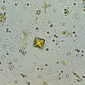 Calcium Oxalate Crystals: Identification & Clinical Significance
