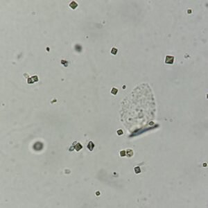 Calcium Oxalate Crystals: Identification & Clinical Significance