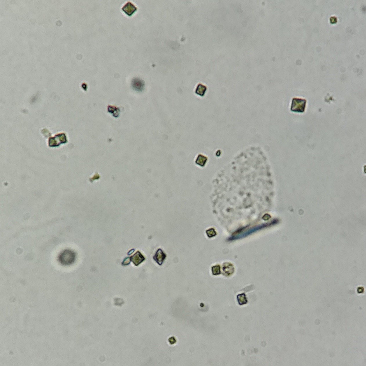 Calcium Oxalate Crystals: Identification & Clinical Significance