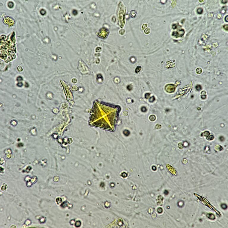 Calcium Oxalate Crystals: Identification & Clinical Significance