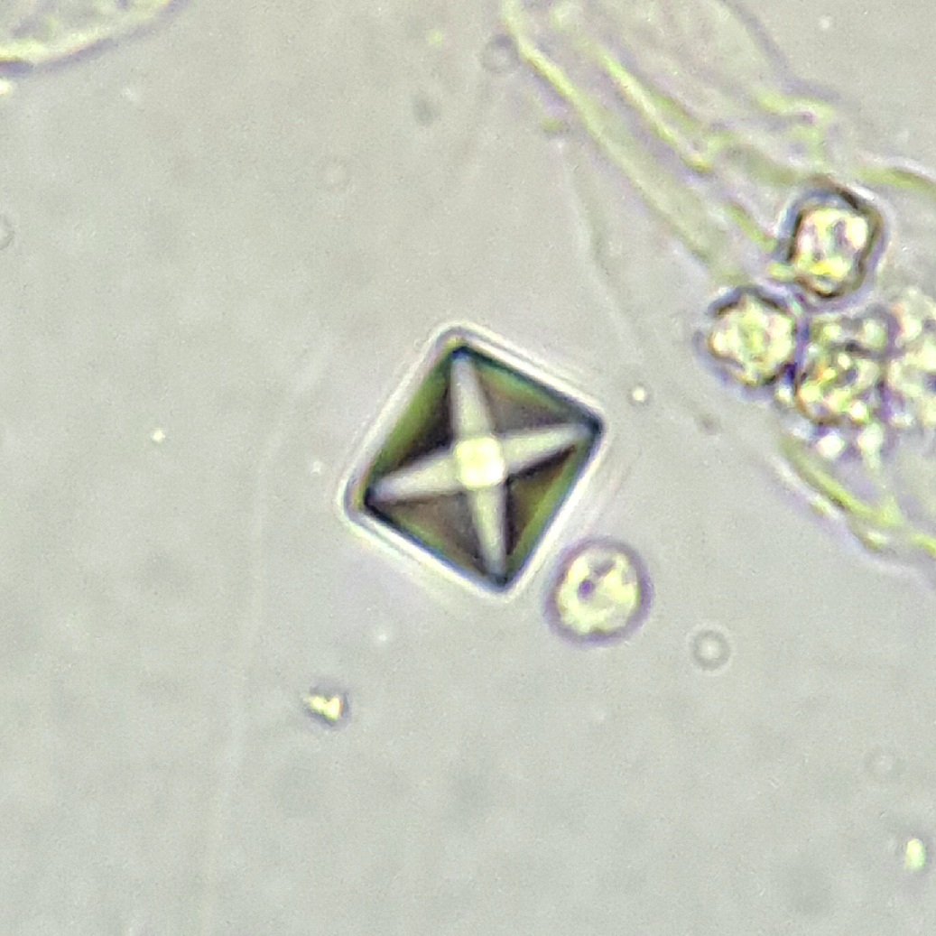 Calcium Oxalate Crystals: Identification & Clinical Significance