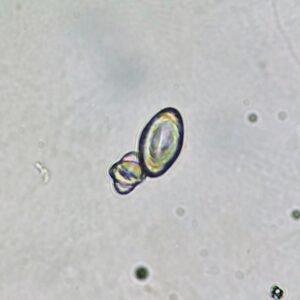 Calcium Oxalate Crystals: Identification & Clinical Significance