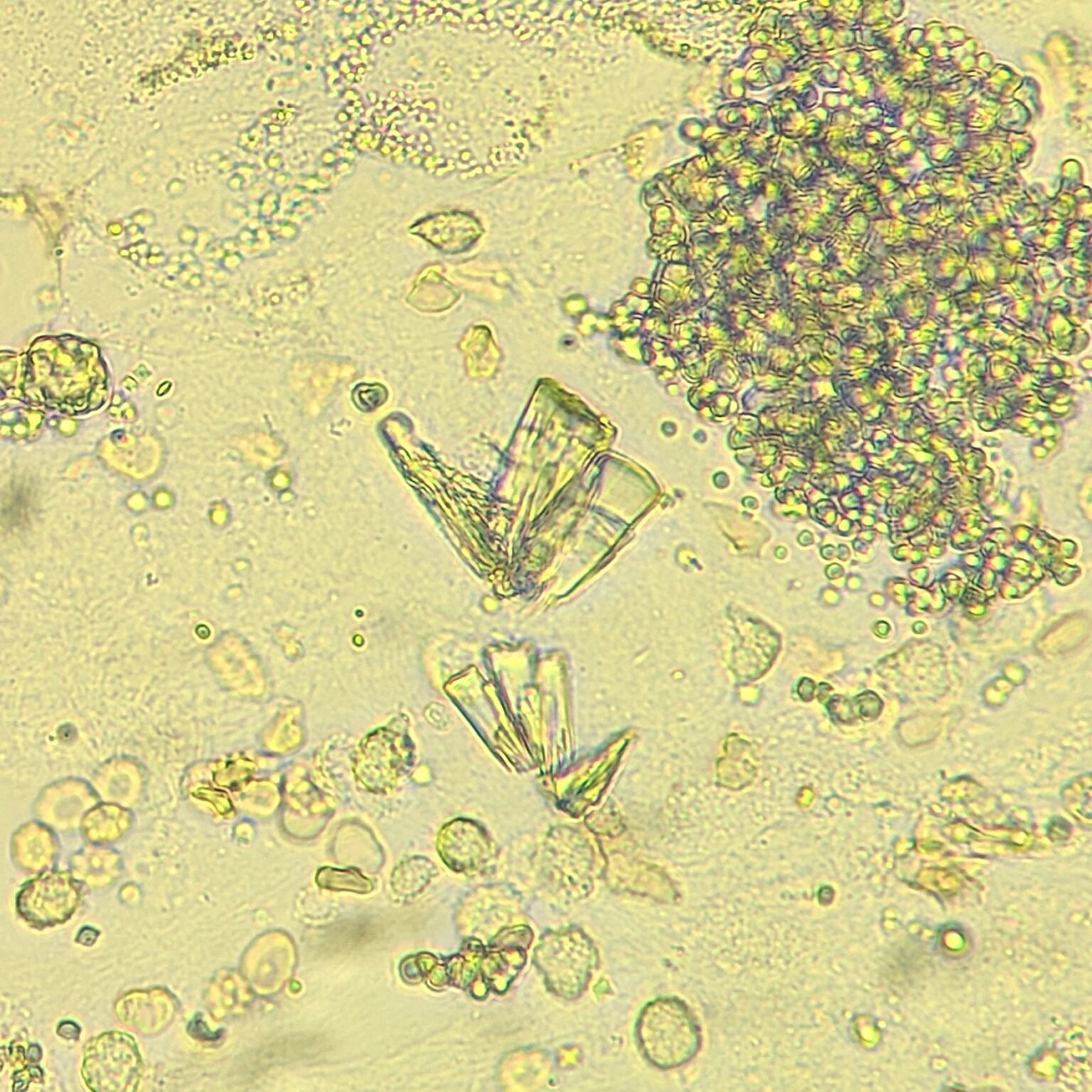 Calcium Phosphate Crystals: Identification & Clinical Significance