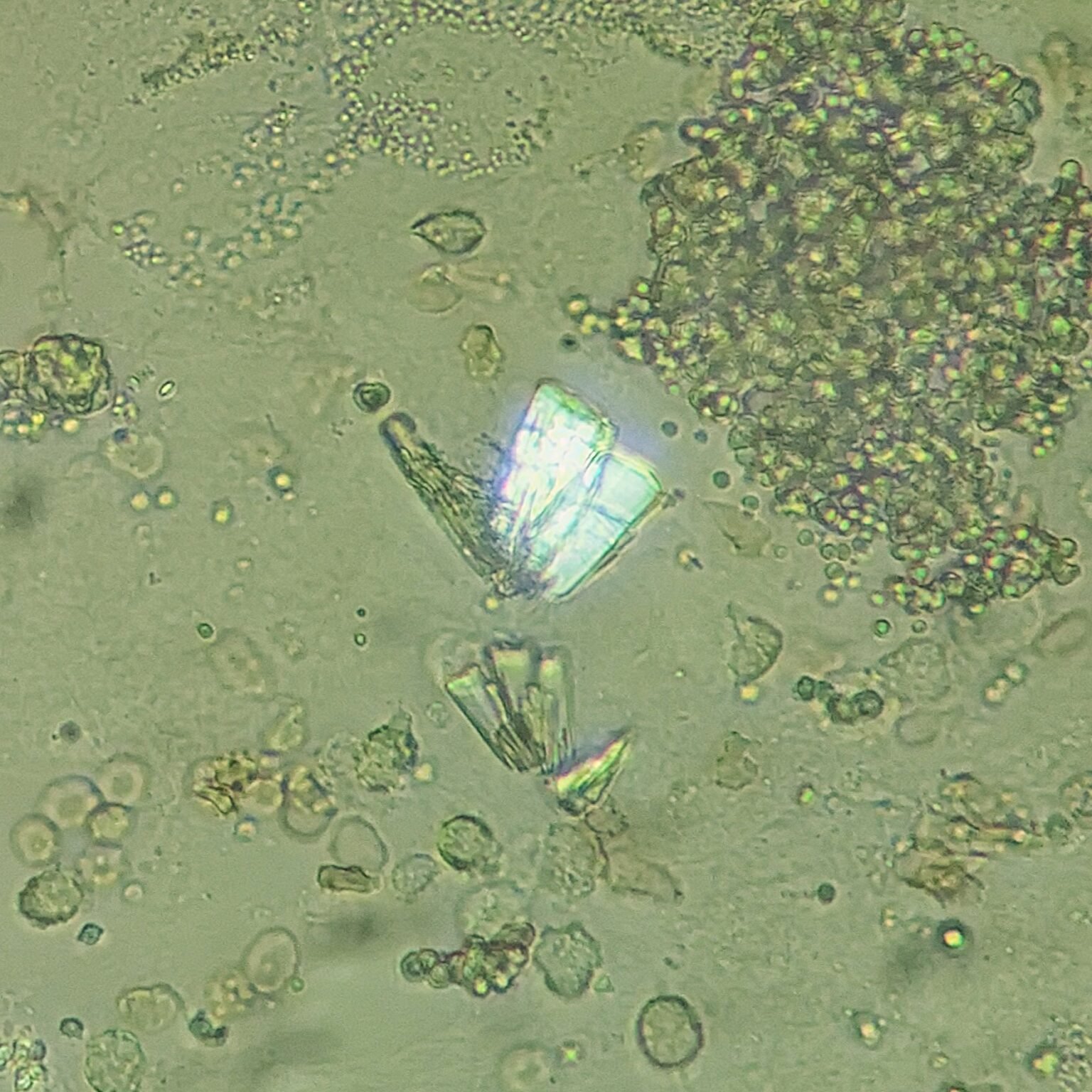 Calcium Phosphate Crystals: Identification & Clinical Significance