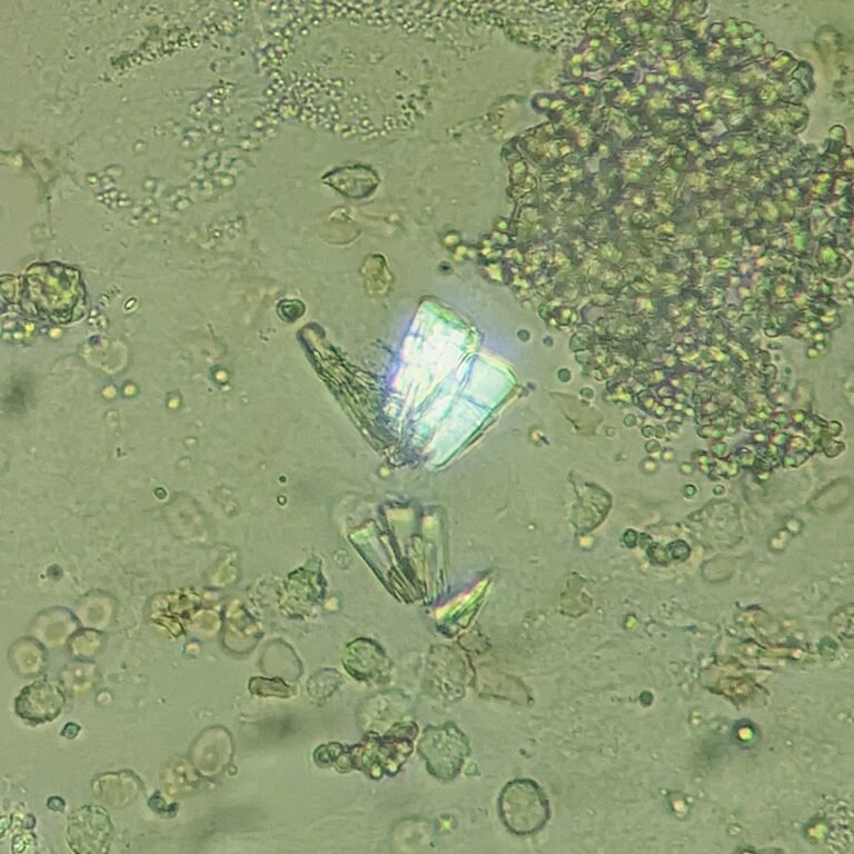 Calcium Phosphate Crystals: Identification & Clinical Significance