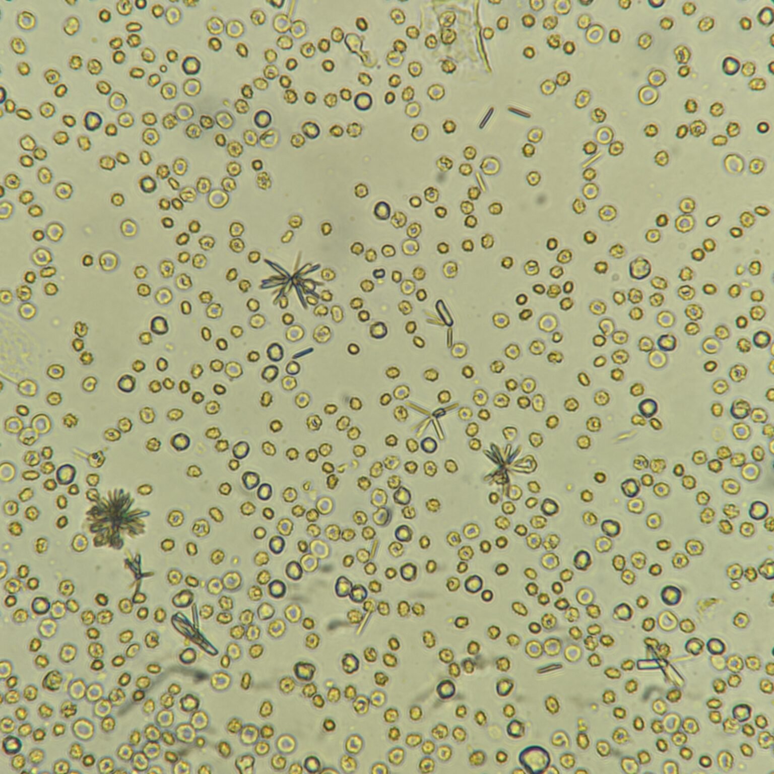 Calcium Phosphate Crystals: Identification & Clinical Significance