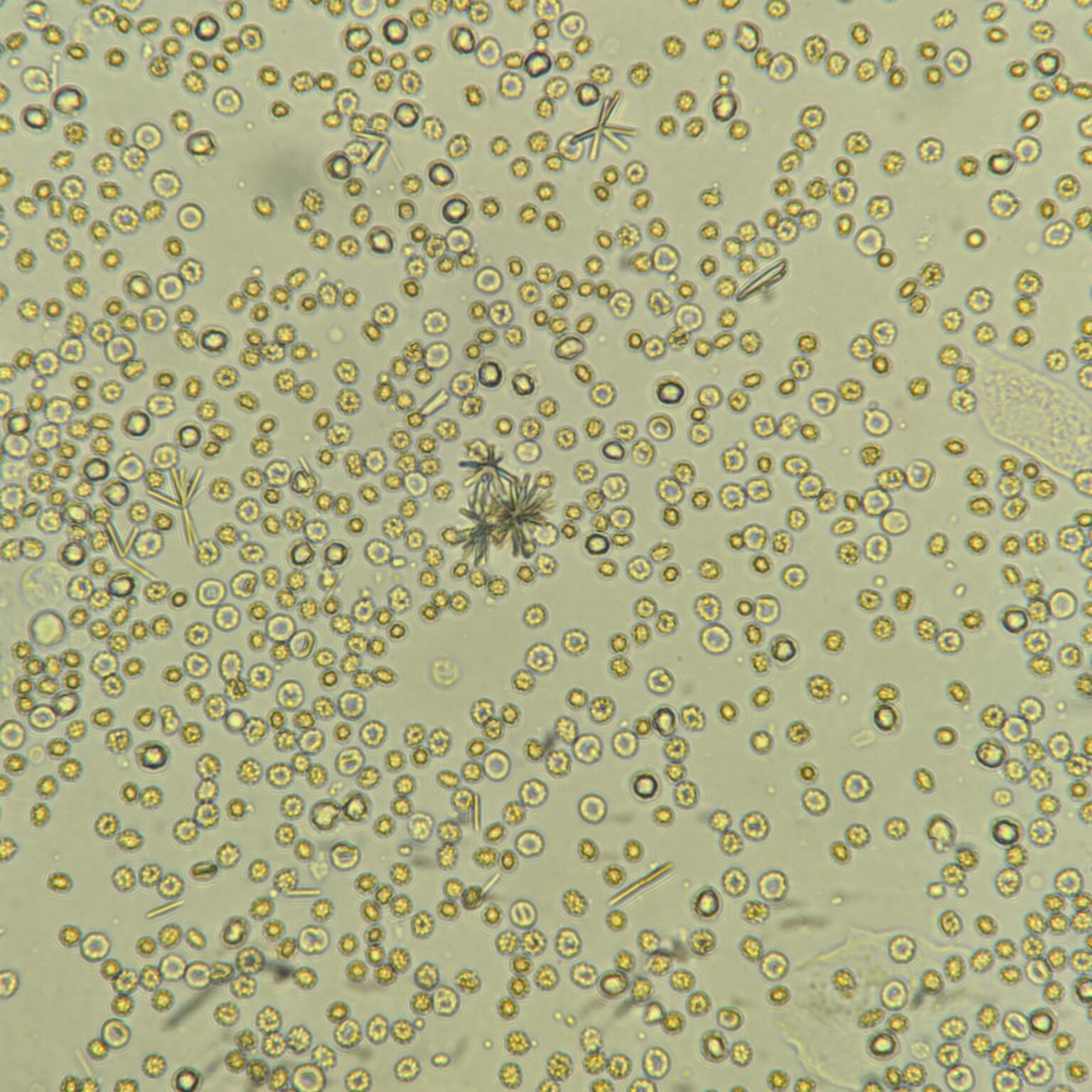 Calcium Phosphate Crystals: Identification & Clinical Significance