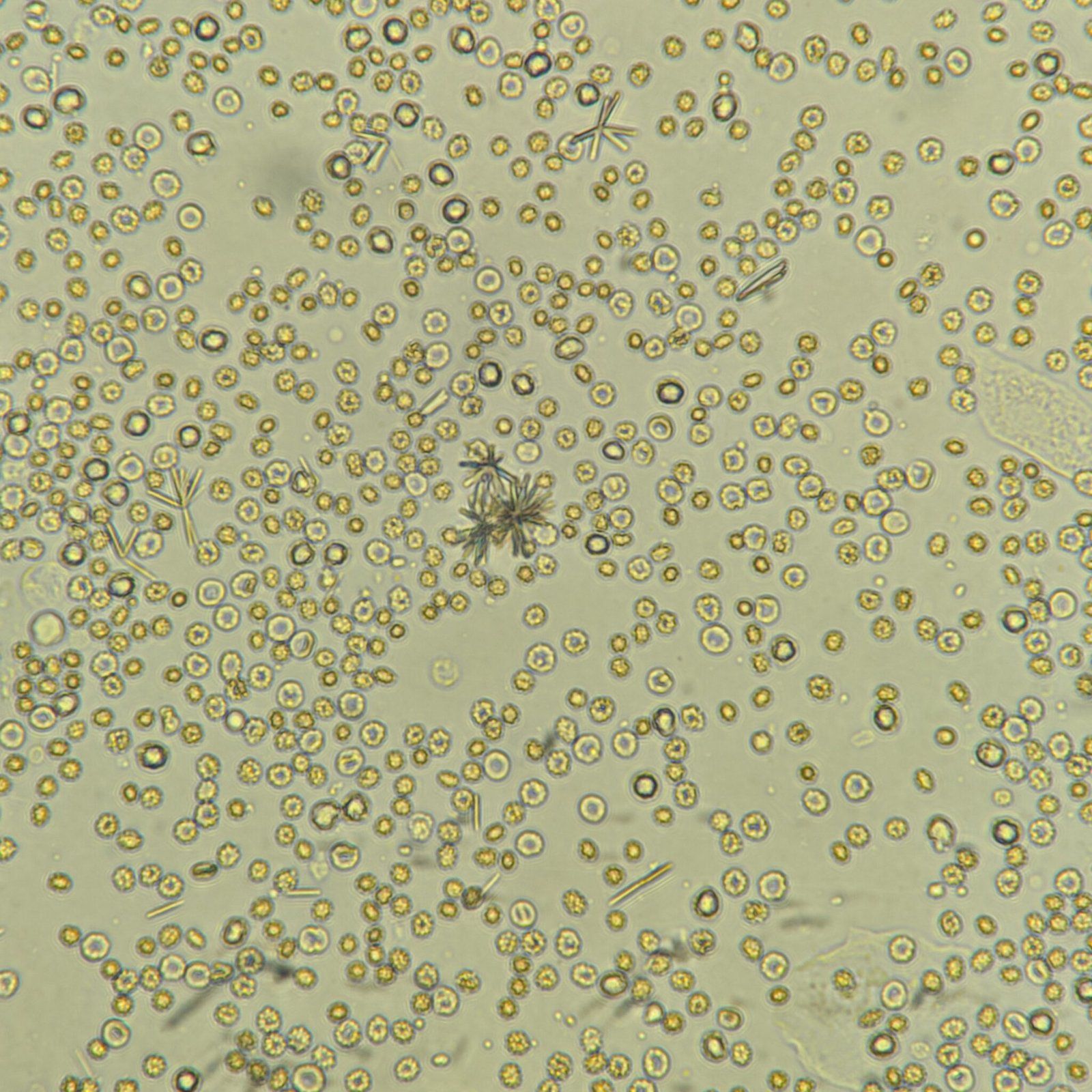 Calcium Phosphate Crystals: Identification & Clinical Significance