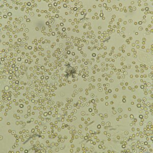 Calcium Phosphate Crystals: Identification & Clinical Significance