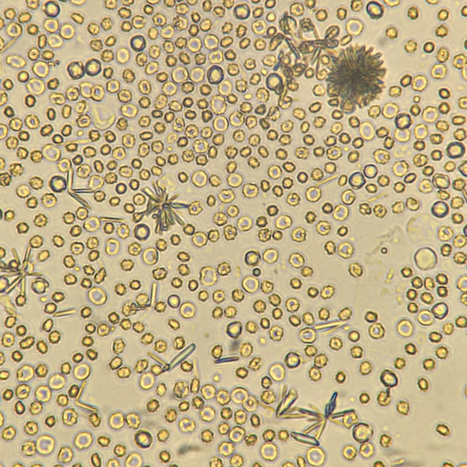 Calcium Phosphate Crystals: Identification & Clinical Significance