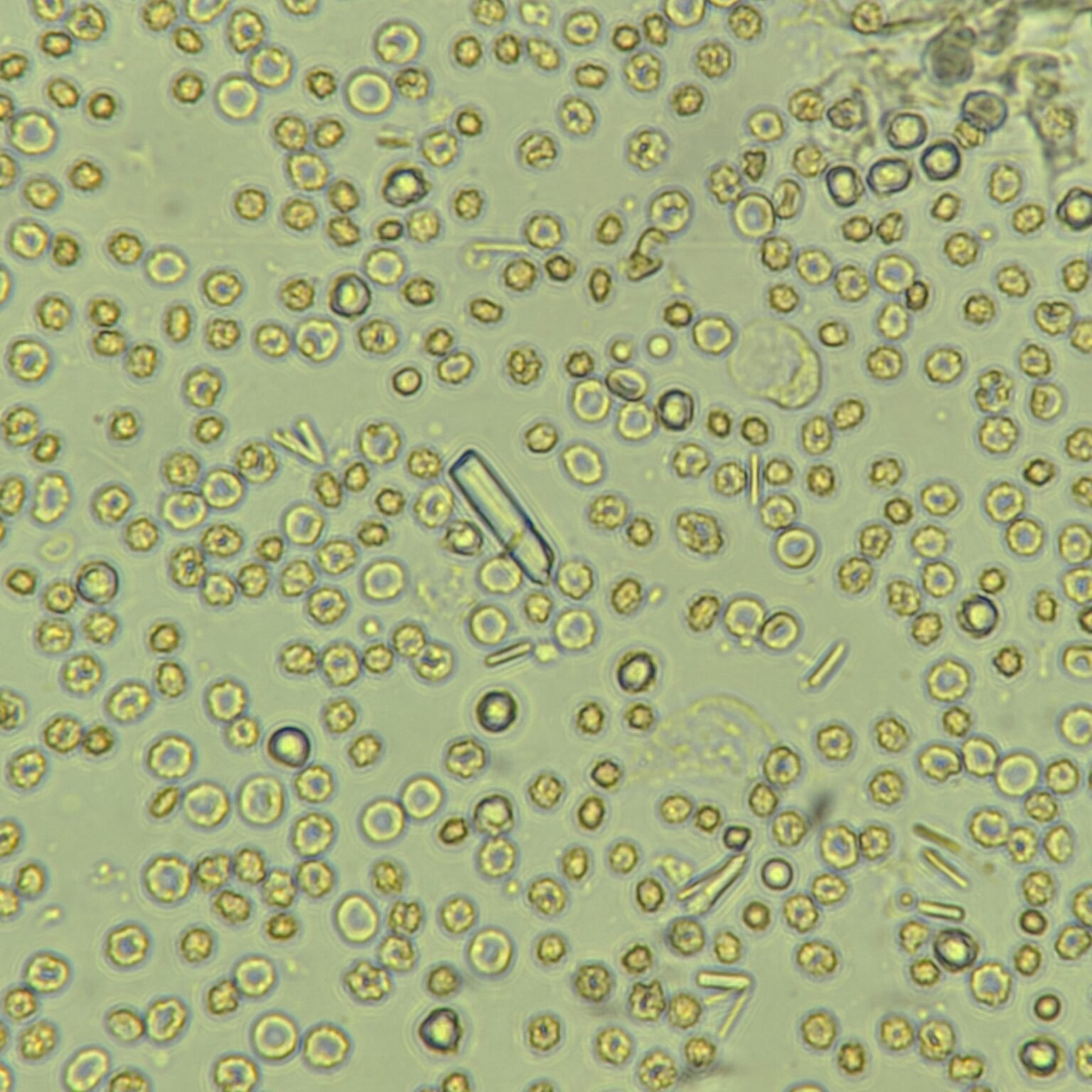 Calcium Phosphate Crystals: Identification & Clinical Significance