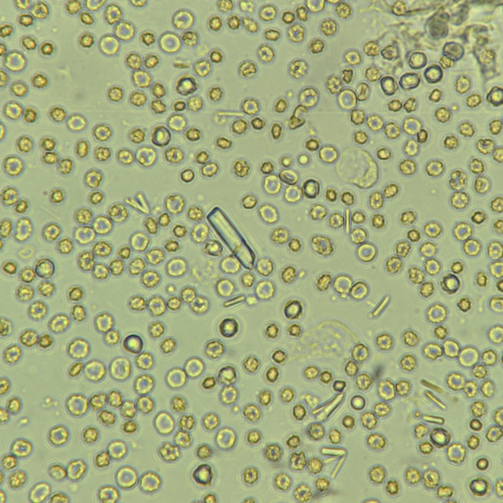 Calcium Phosphate Crystals: Identification & Clinical Significance