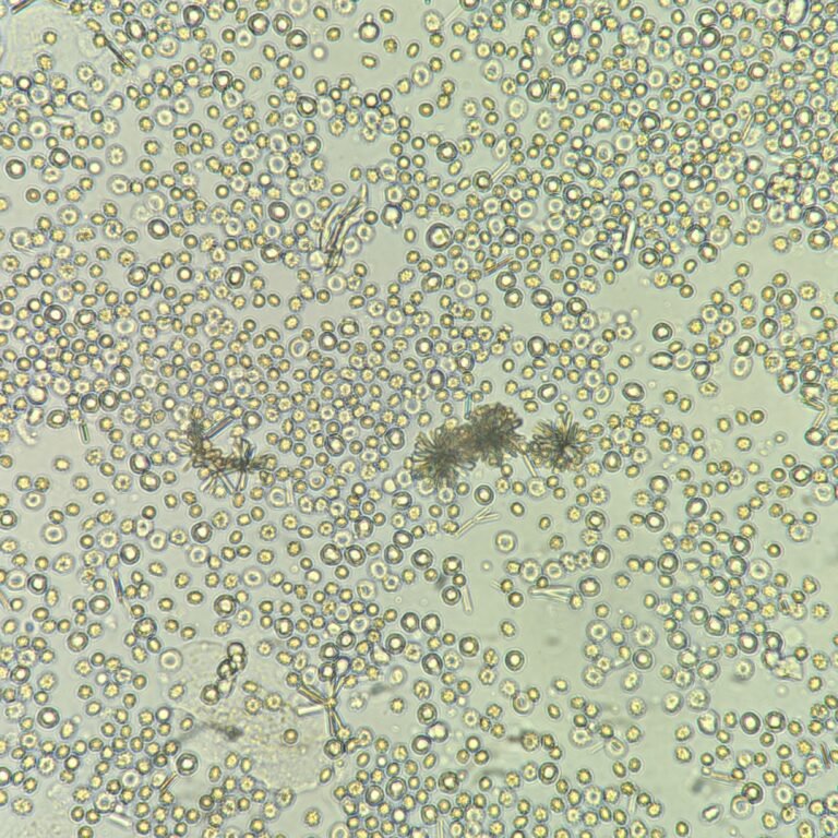 Urinary Crystals: Identification & Clinical Significance