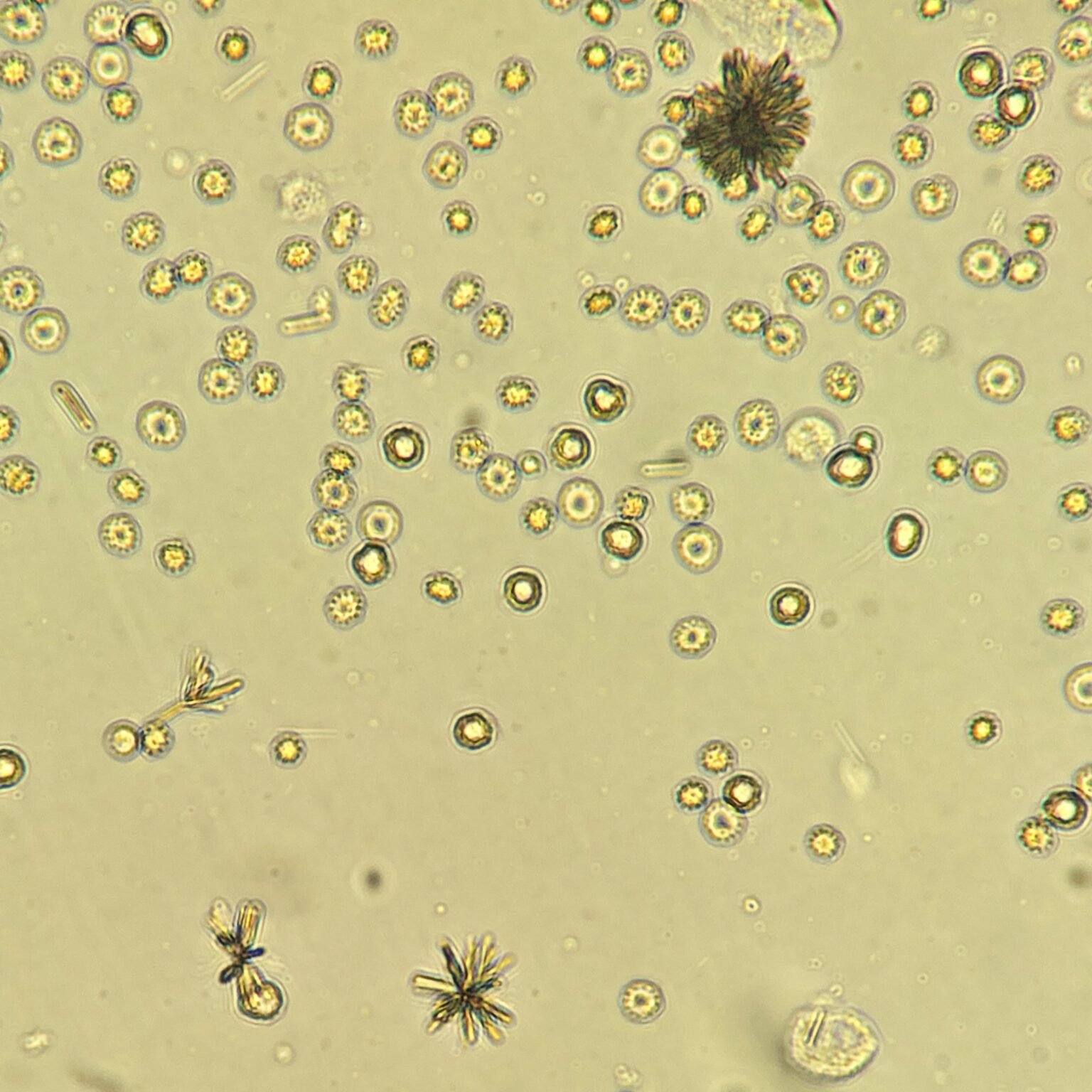 Calcium Phosphate Crystals: Identification & Clinical Significance