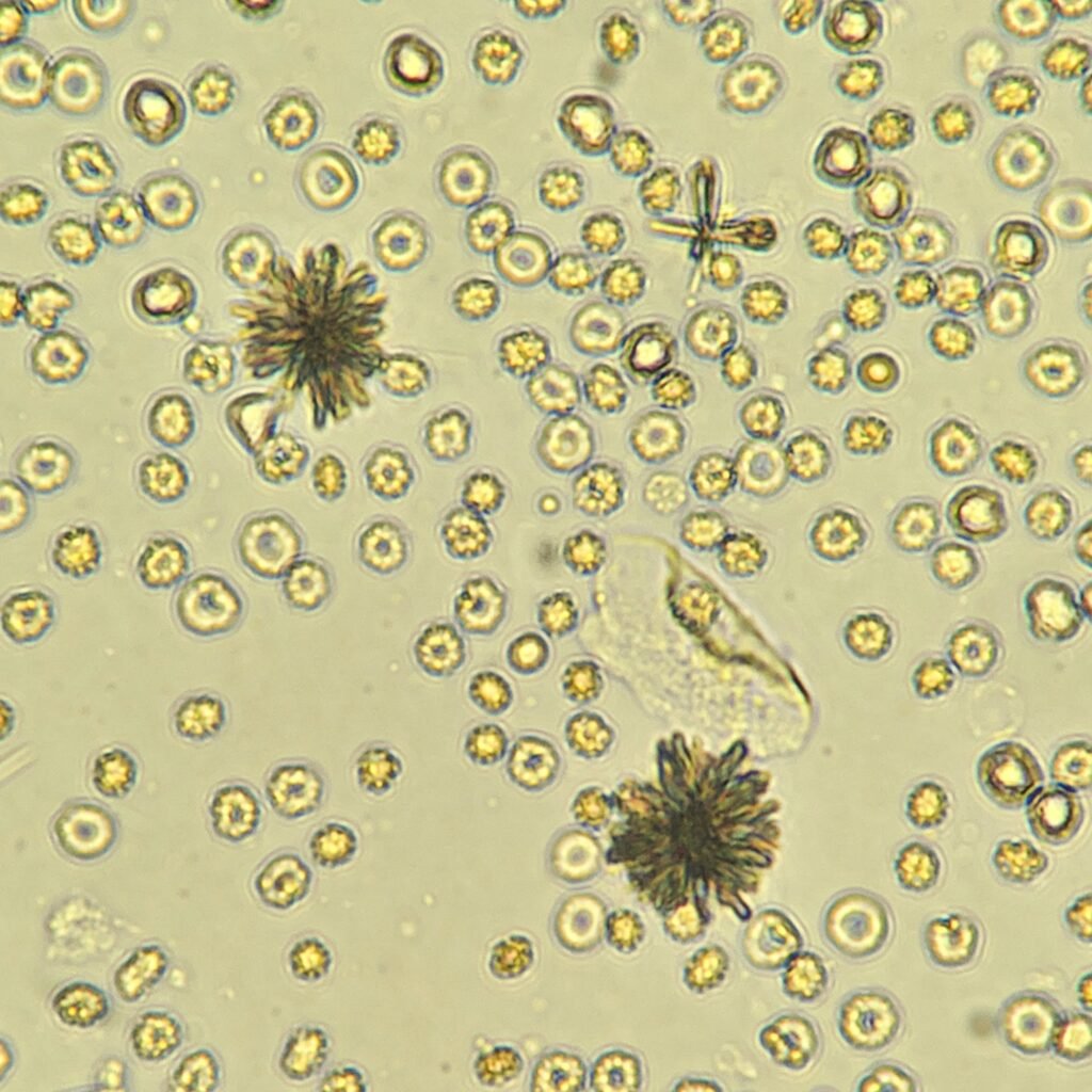 Calcium Phosphate Crystals: Identification & Clinical Significance