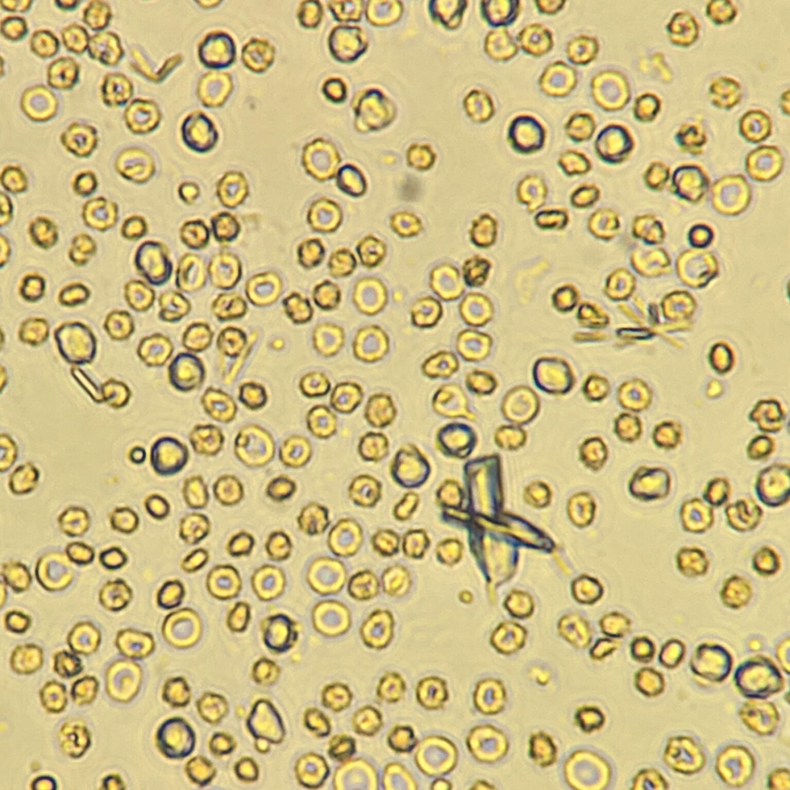 Calcium Phosphate Crystals: Identification & Clinical Significance
