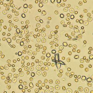 Calcium Phosphate Crystals: Identification & Clinical Significance